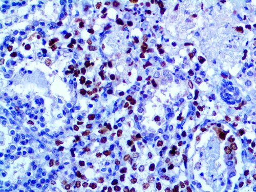 Herpes Simplex Virus I -MMab | Cancer Diagnostics Inc.